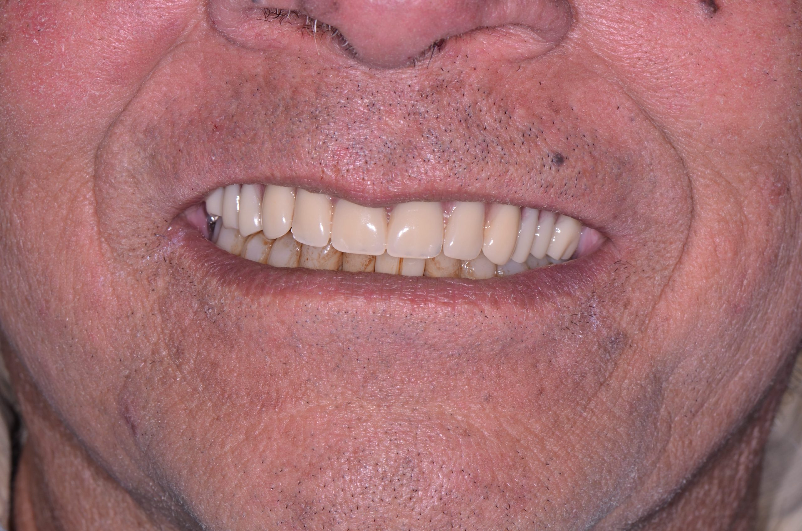Implant Retained Fixed Dentures – AADIC