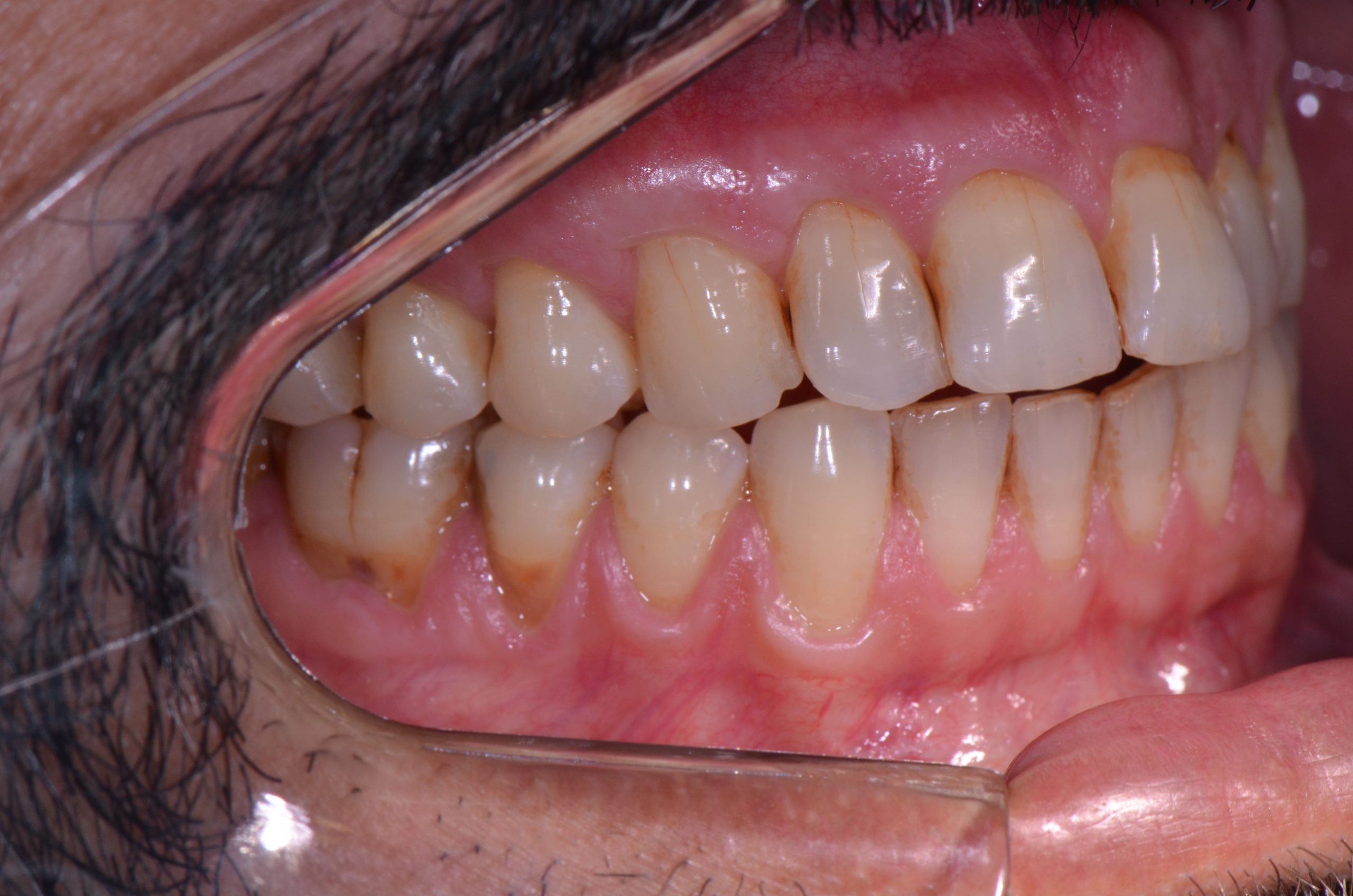 Gum Grafting Or Recession Coverge – AADIC