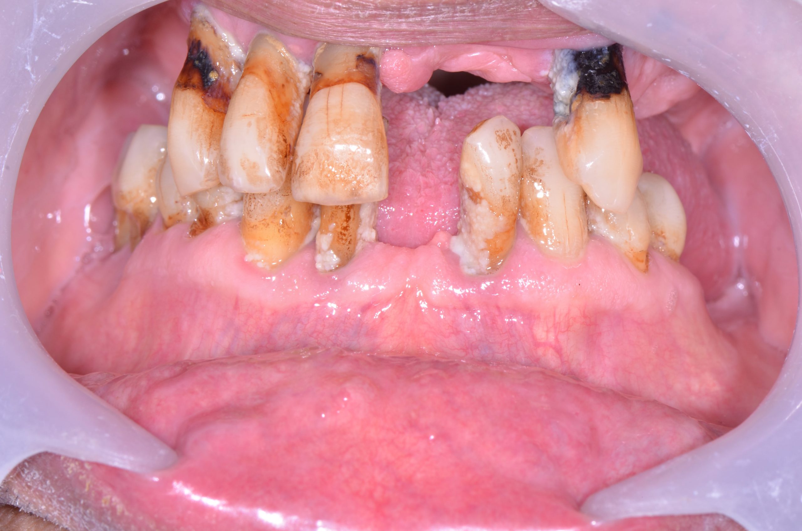 Implant Retained Fixed Dentures – AADIC